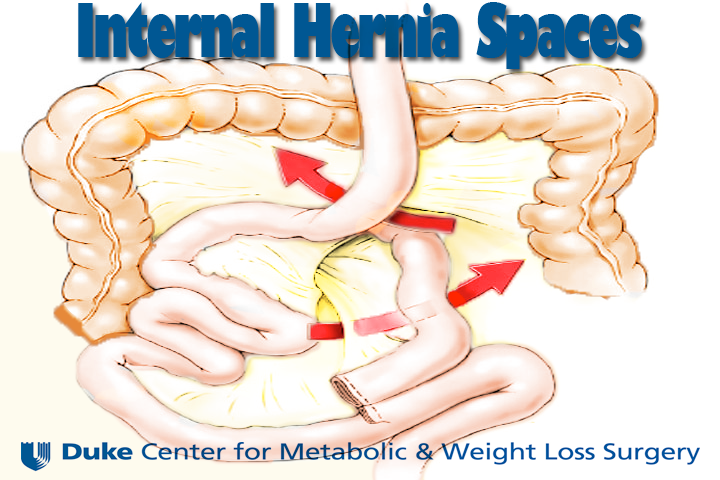 internal hernia – Bariatric Surgery Education
