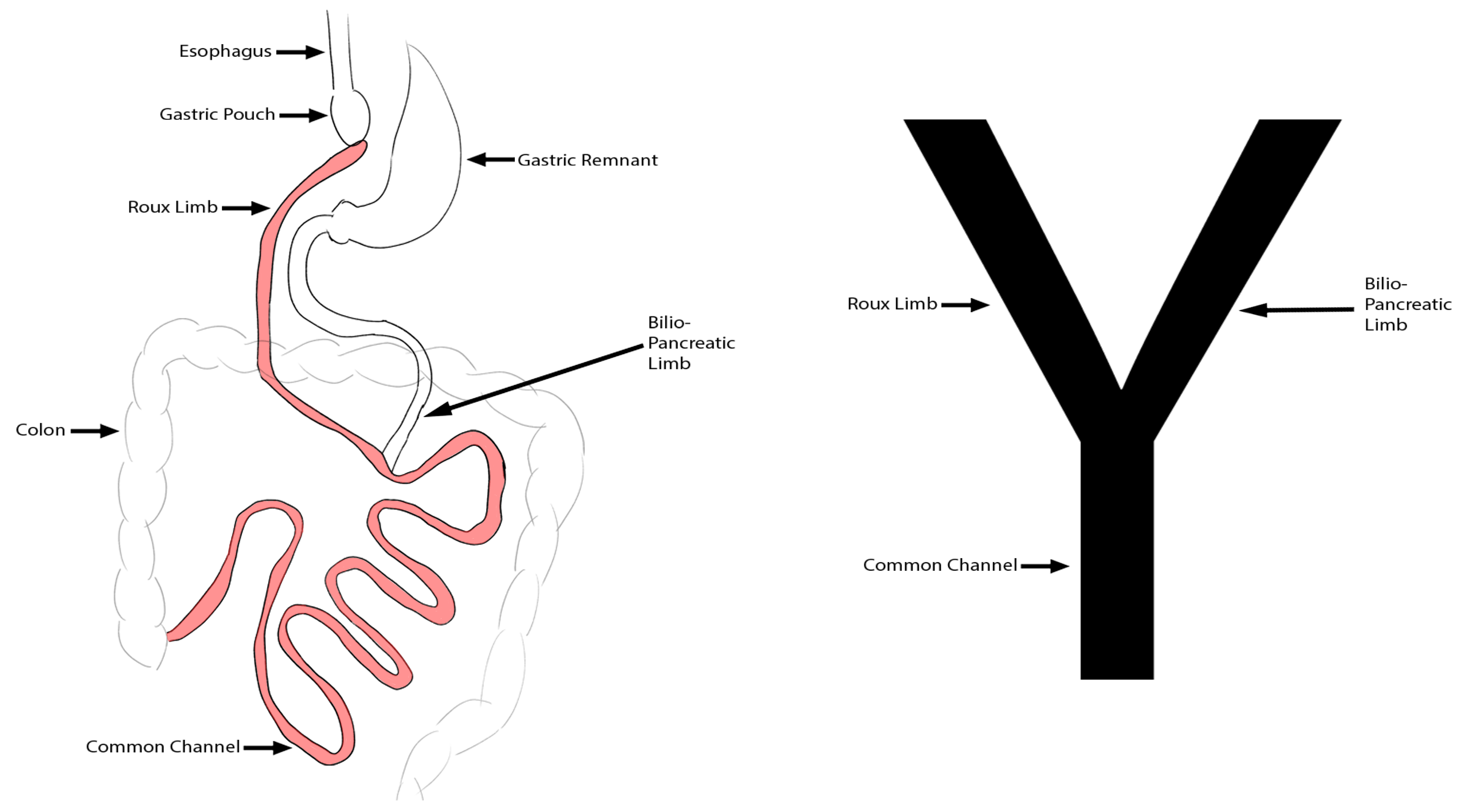 RYGB_Standard_Distal_Comparison – Bariatric Surgery Education